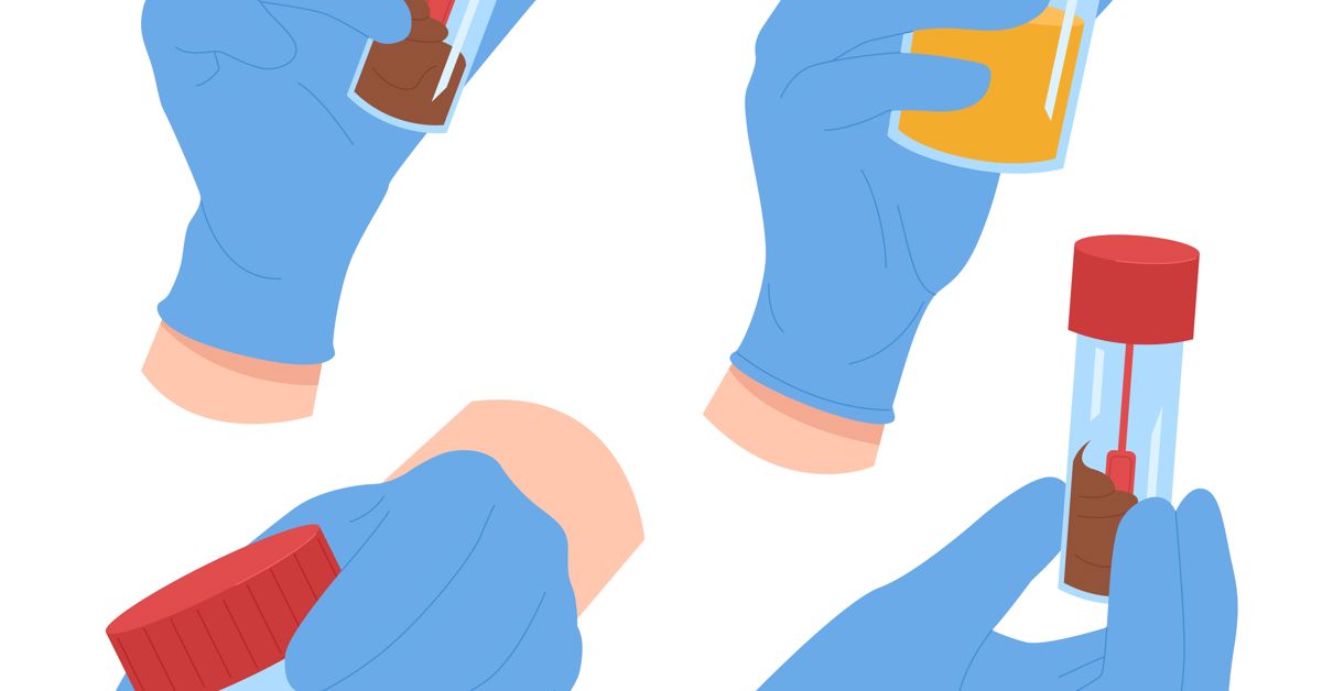 Ny analysemetode for kalprotektin - Helse Bergen HF