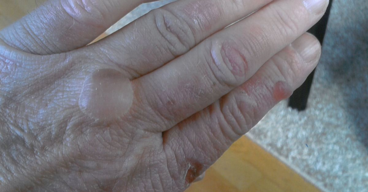 PCT: Tilbakefall med skjør hud og blemmer - Helse Bergen HF